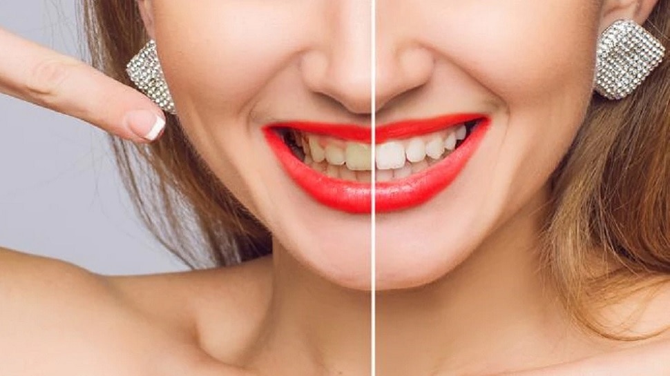 5 Home Remedies To Whiten And Brighten Teeth: మీ దంతాలు తెల్లగా ...