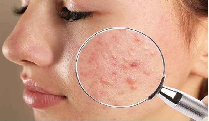 How to prevent pimples on your face, here are the simple health tips ...
