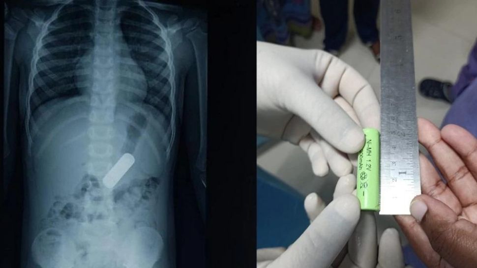 four years boy swallowed the 5 cm battery, doctors save the child ...