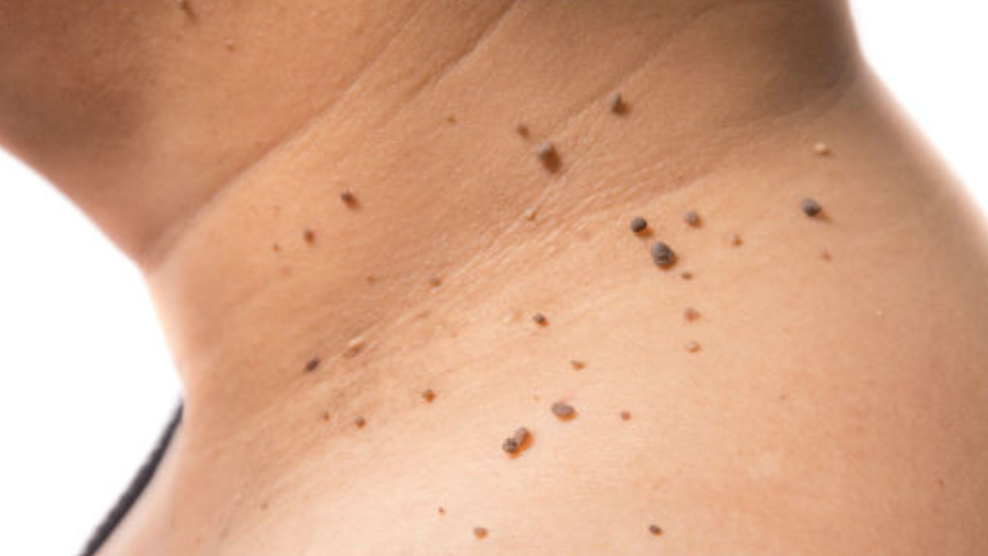 Pulipirlu Remove Medicine: Who Suffer From Warts Can Get Rid Of Using ...