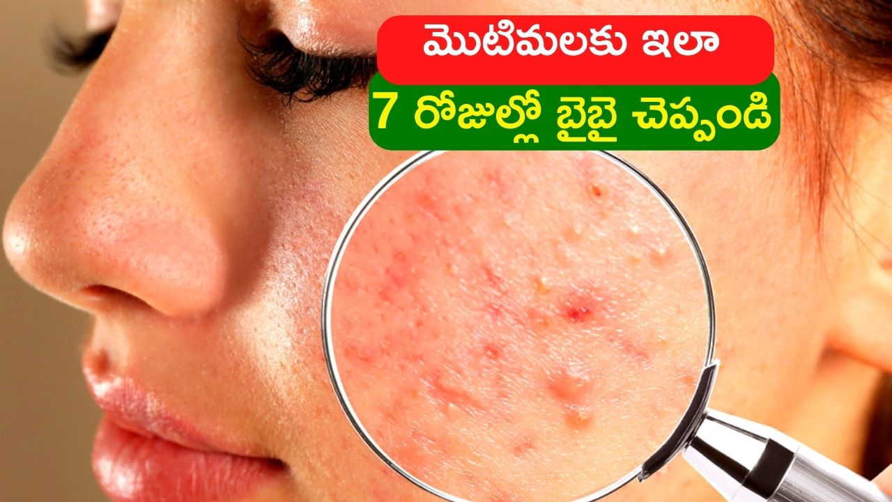 How To Remove Pimples: Applying Rose Water Aloe Vera Rose Water Multani ...
