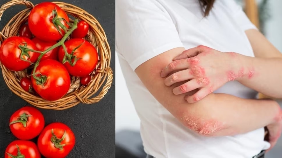 Health tips and precautions with tomato usage, excess use of tomato can ...