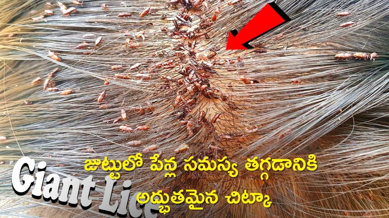 How To Make Anti Lice Hair Oil: Lice Problem Will Reduce In 4 Days With ...