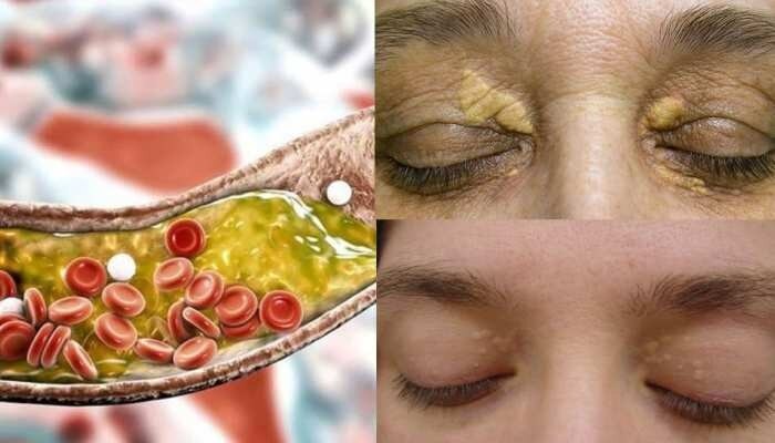 Cholesterol tips and precaution how to detect it what are the easy ...