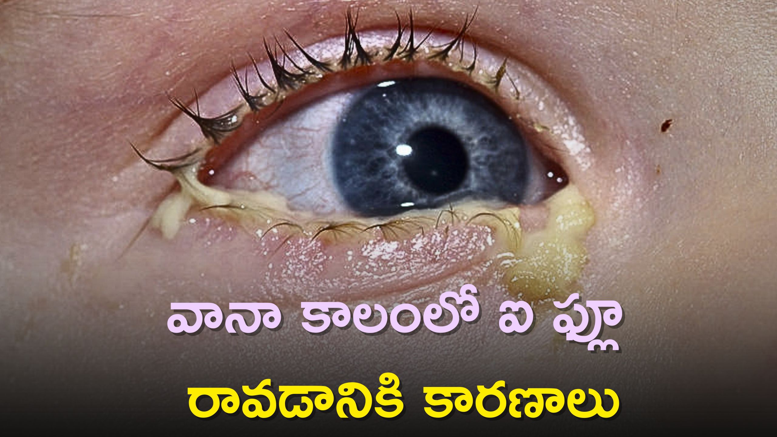 Eye Flu Causes Symptoms And Relief Tips For Eye Flu During Monsoon ...