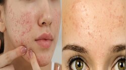 Pimple free skin News in Telugu, Latest Pimple free skin news, photos ...