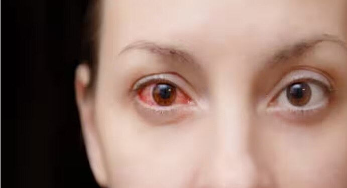 Eye infections and flu precautions dos and donts of eye diseases | Eye ...