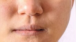Reasons for Dry Skin in Winter News in Telugu, Latest Reasons for Dry ...