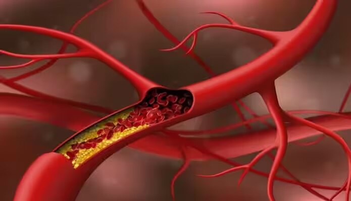 Cholesterol risk and reasons how to lower cholesterol levels in body ...