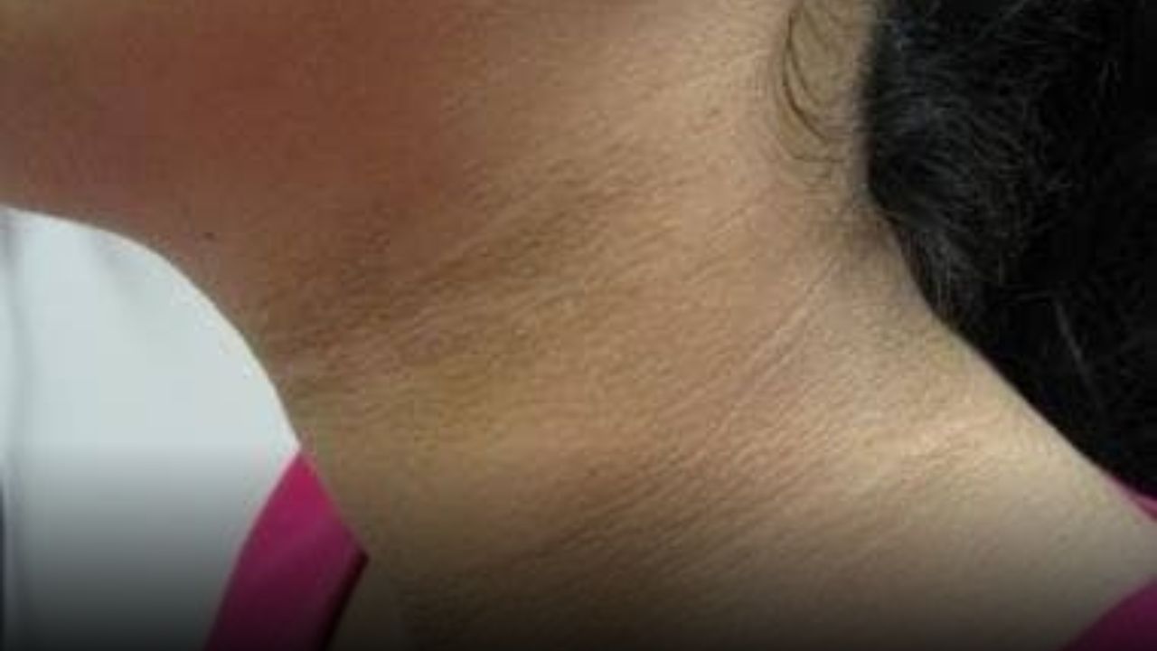 These Are The Signs Of The Acanthosis Nigricans Be Careful | Reasons ...