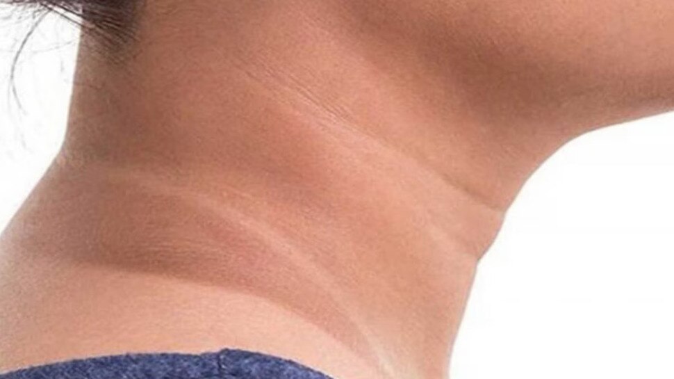 Do you have dark spots around your neck then try this dark neck ...