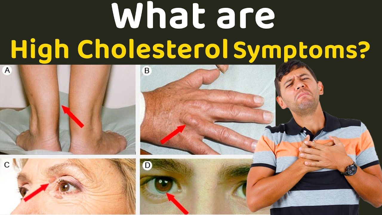 High Cholesterol Symptoms You Must Notice Them Before It Turns Serious ...