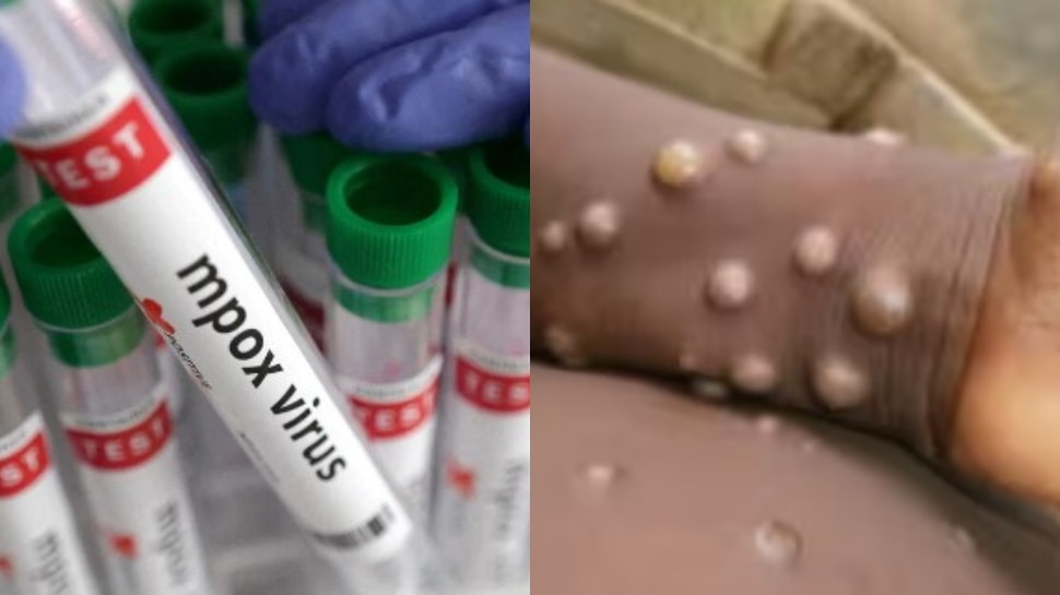 first mpox case detected in delhi union health ministry issues advisory ...