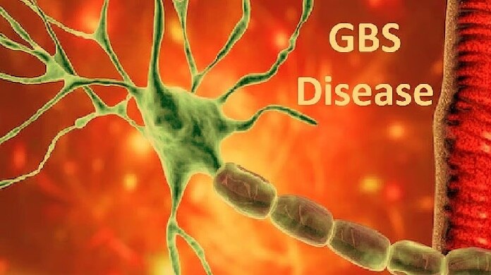 Guillain Barre Syndrome Alert in Andhra Pradesh first Case of fatality reported | GBS Disease ...