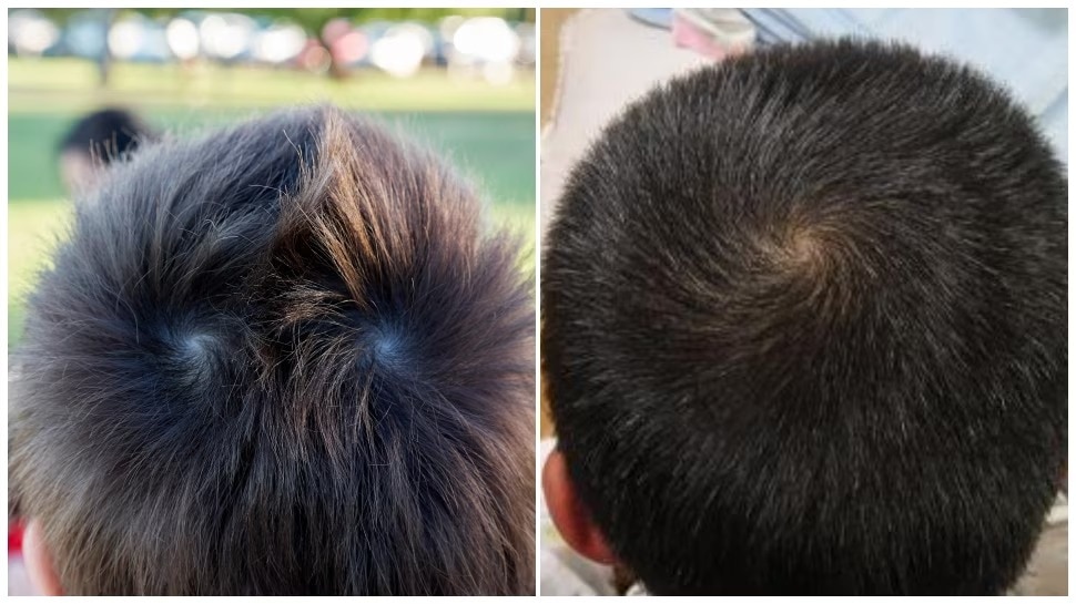 Hair Whorl Significance: Will two marriages happen if there are two ...