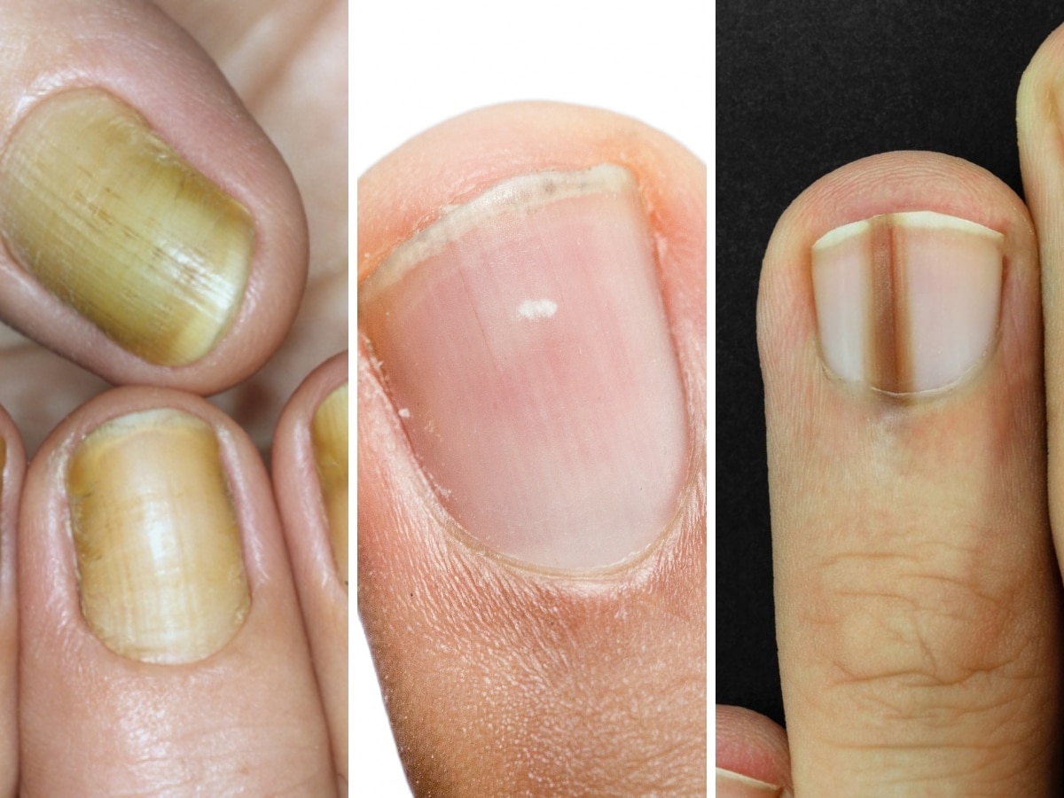 Nails Color and Symptoms indicates liver, kidneys, diabetes and heart ...