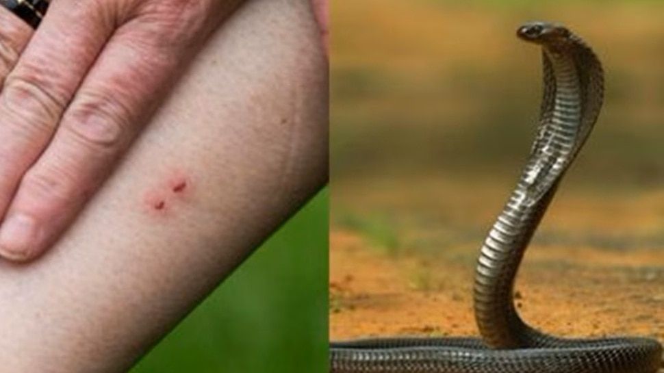 Snake Bite Remedy Instant Solution to Stop Poison Spread Quick First ...