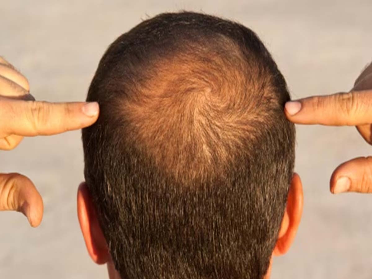 Hair Fall Control Tips and home made Remedies apply this thrice in a ...