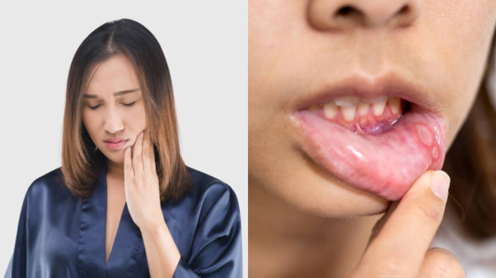 Mouth ulcer causes symptoms and vitamin b 12 folic acid deficiancy ...