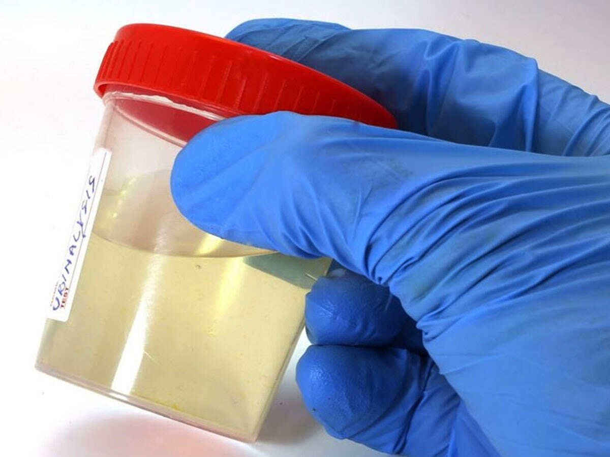 Urine Color and its indication of health problems check your urine ...